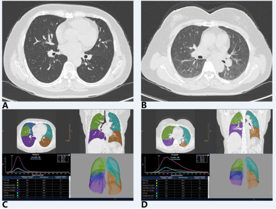 Diagnostics | Free Full-Text | Total Lung and Lobar Quantitative ...