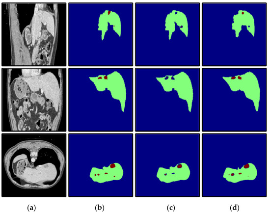 Two-Stage Liver and Tumor Segmentation Algorithm Based on Convolutional ...
