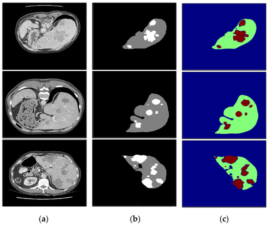 Two-Stage Liver and Tumor Segmentation Algorithm Based on Convolutional ...