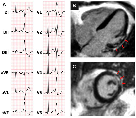 Diagnosis and Treatment of Idiopathic Premature Ventricular ...
