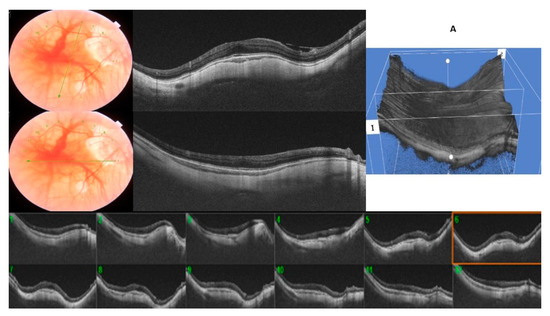Dome-Shaped Macula versus Ridge-Shaped Macula Eyes in High Myopia Based ...