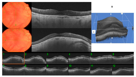 Dome-Shaped Macula versus Ridge-Shaped Macula Eyes in High Myopia Based ...