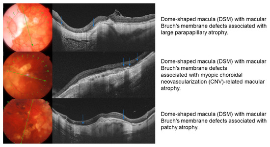 Dome-Shaped Macula versus Ridge-Shaped Macula Eyes in High Myopia Based ...