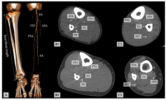 Computed Tomography Angiography (CTA) before Reconstructive Jaw Surgery ...