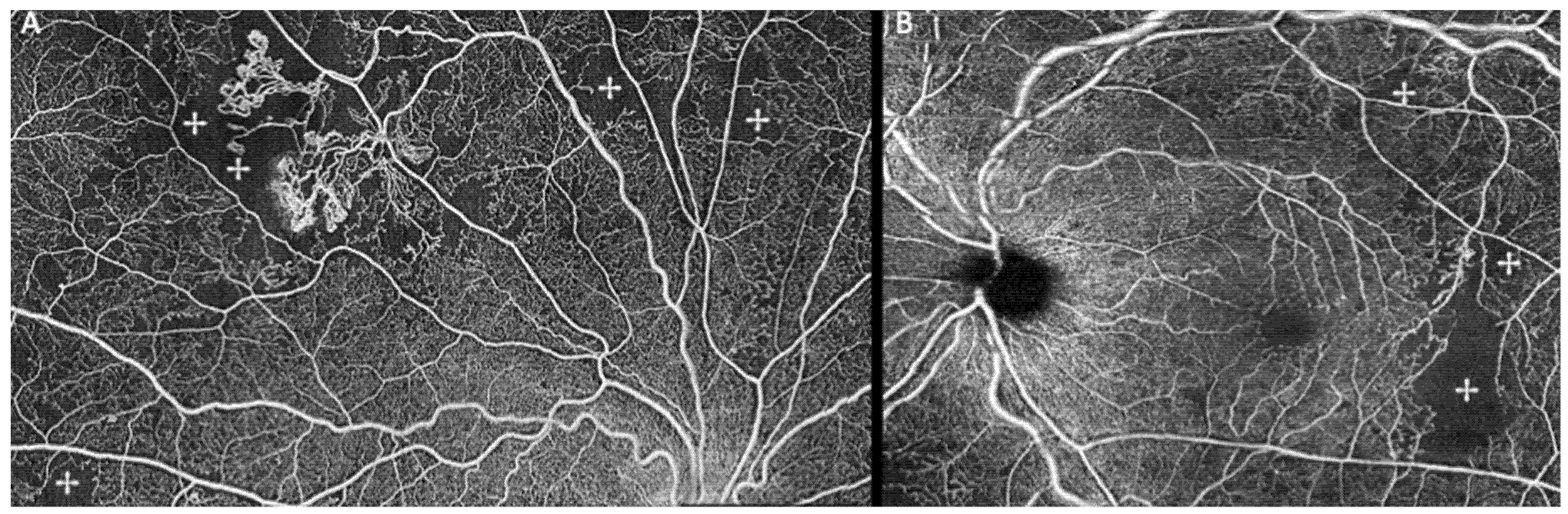 Diagnostics | Free Full-Text | Update on Optical Coherence Tomography ...
