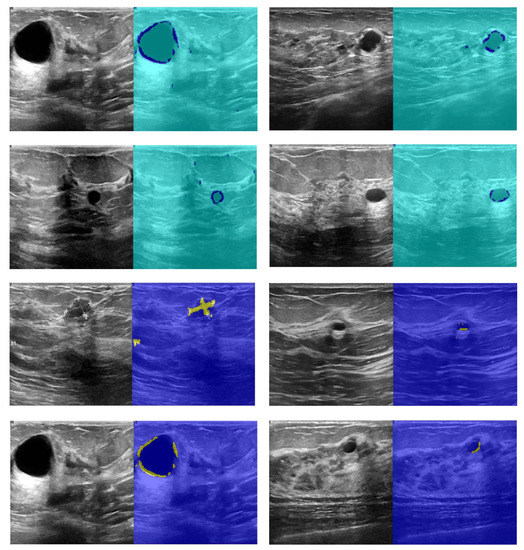 Presentation of Novel Architecture for Diagnosis and Identifying Breast ...