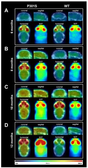 Diagnostics | Free Full-Text | Longitudinal Assessment of Tau-Associated Pathology by 18F ...