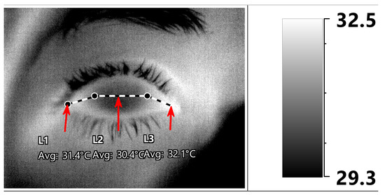 Ocular Surface Temperature: Characterization in a Large Cohort of ...
