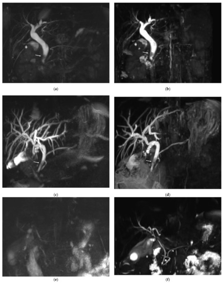 Diagnostics | Free Full-Text | Single-Breath-Hold MRI-SPACE Cholangiopancreatography with ...