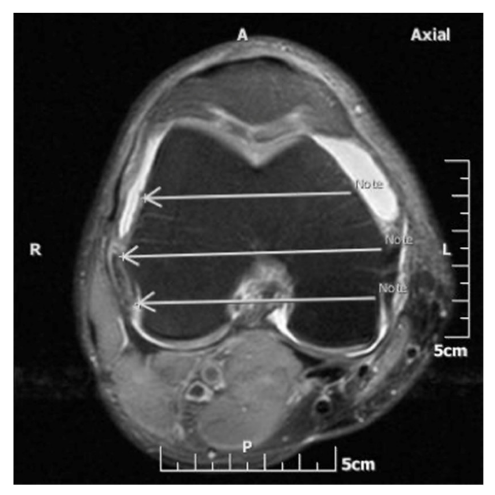 Knee Capsule Anatomy: An MR Imaging and Cadaveric Study