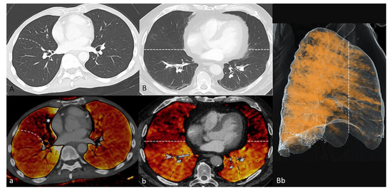 Dual-Energy Lung Perfusion in Portal Venous Phase CT—A Comparison with ...
