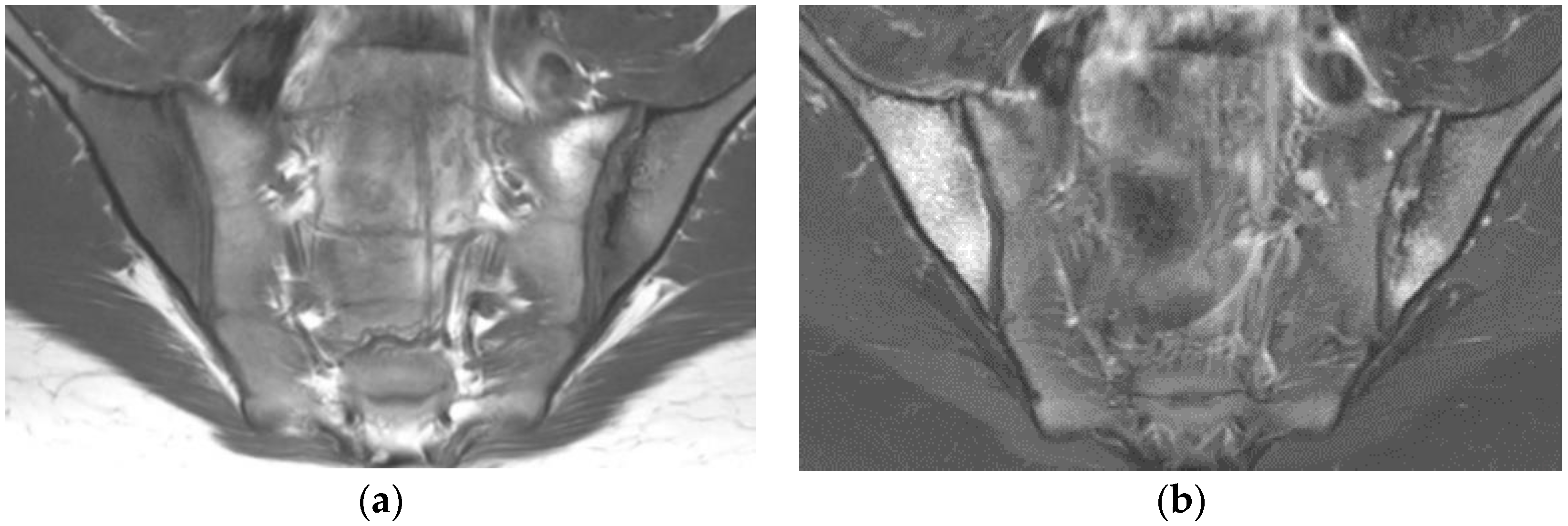 Main Diagnostic Pitfalls in Reading the Sacroiliac Joints on MRI