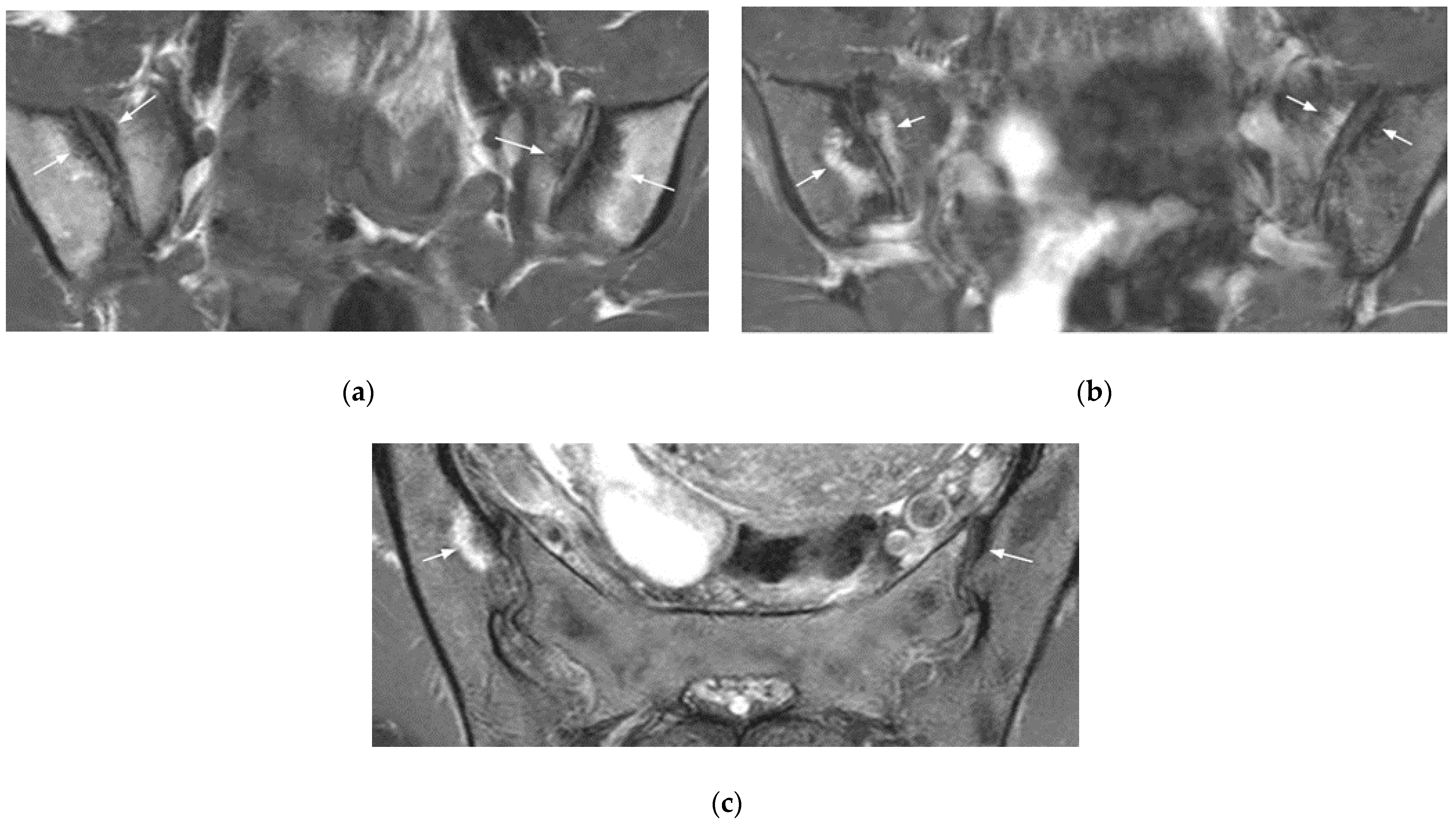 Sacroiliac Joint Erosion