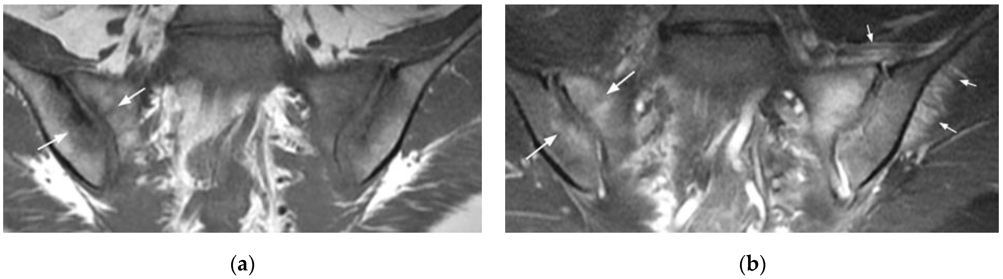 Main Diagnostic Pitfalls in Reading the Sacroiliac Joints on MRI