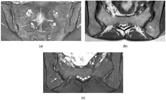 Main Diagnostic Pitfalls in Reading the Sacroiliac Joints on MRI