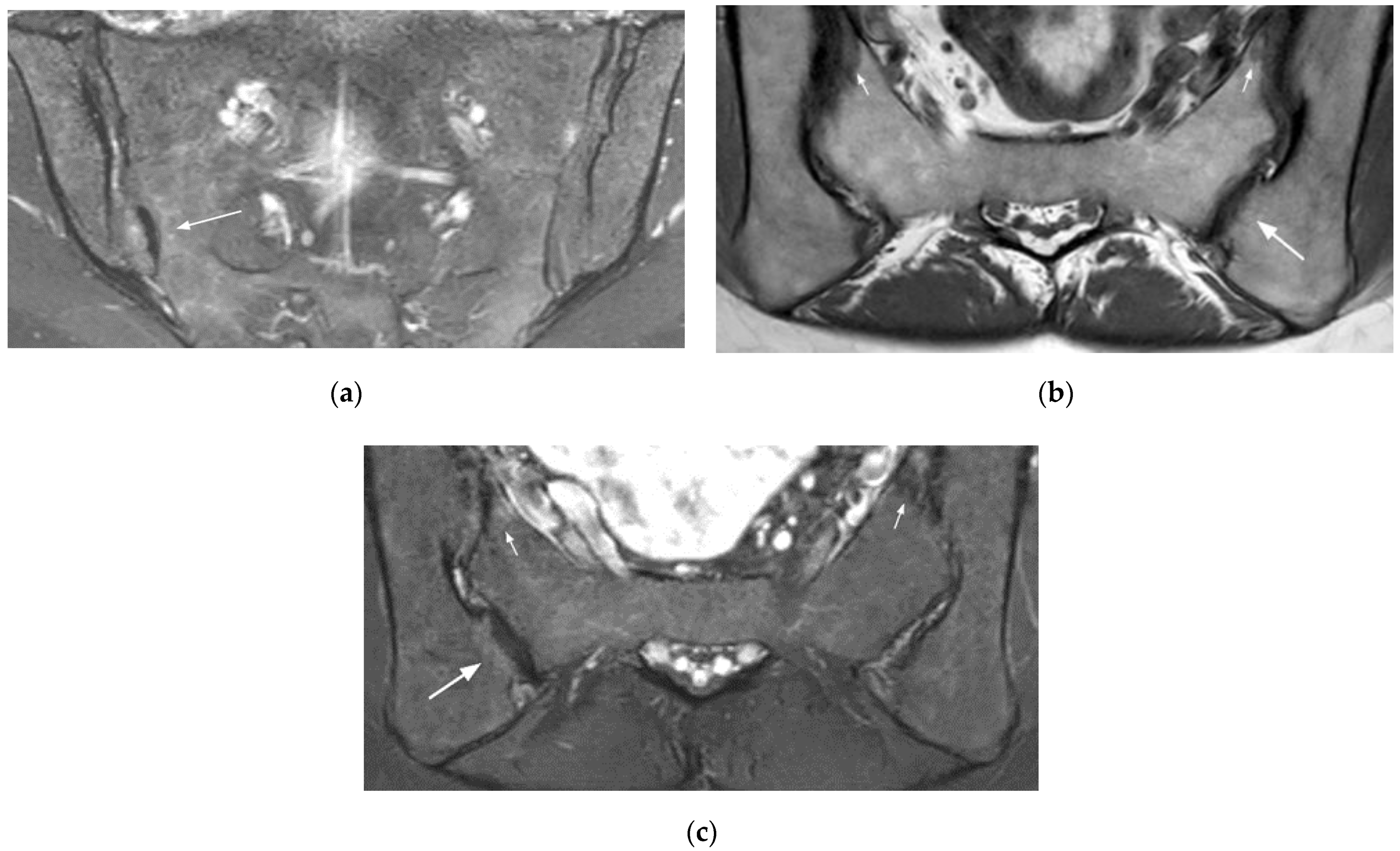 Sacroiliac Joint Erosion