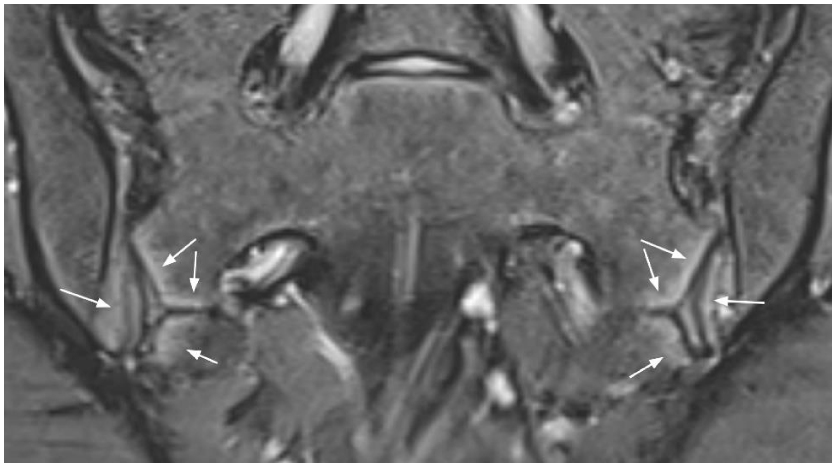 Main Diagnostic Pitfalls in Reading the Sacroiliac Joints on MRI