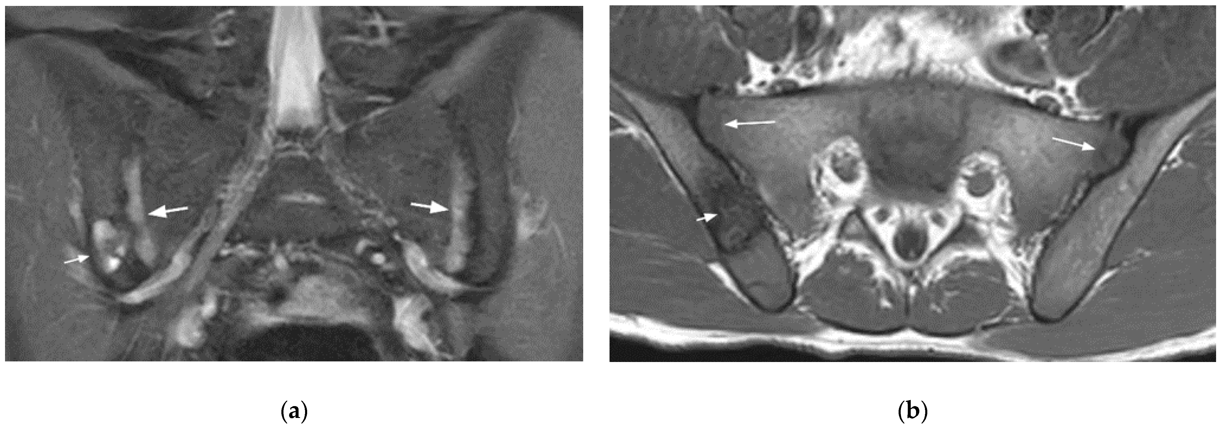 Main Diagnostic Pitfalls in Reading the Sacroiliac Joints on MRI