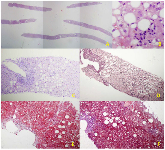 Role of Endoscopic Ultrasound in Liver Disease: Where Do We Stand?