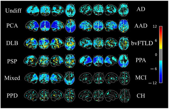 Alzheimer’s Disease-Related Metabolic Pattern in Diverse Forms of ...