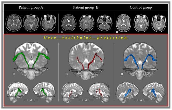 Relationship between Dizziness and the Core Vestibular Projection ...
