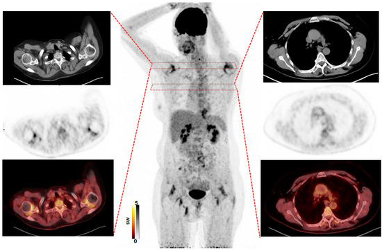 Diagnostics | Free Full-Text | Whole-Body [18F]FDG PET/CT Can Alter ...