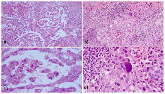 Next-Generation Sequencing Whole-Genome Analysis for Targeted Treatment ...