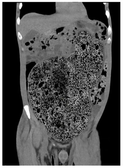Idiopathic Megacolon—Short Review