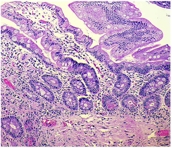 Chronic Autoimmune Gastritis: Modern Diagnostic Principles