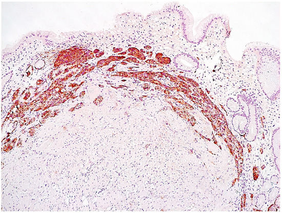 Chronic Autoimmune Gastritis: Modern Diagnostic Principles