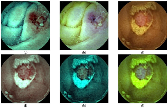 Image-Enhanced Capsule Endoscopy Improves the Identification of Small ...