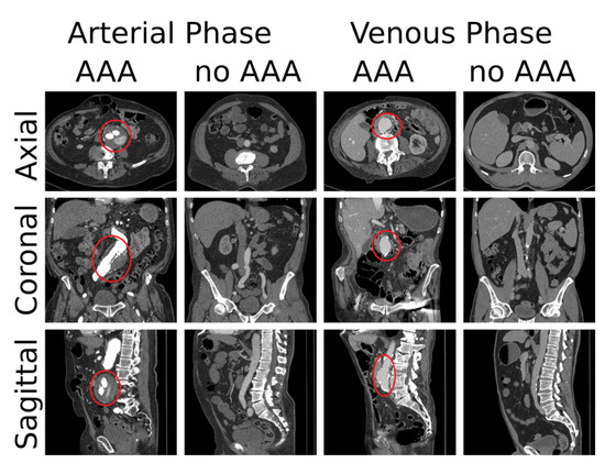 Automated Screening for Abdominal Aortic Aneurysm in CT Scans under ...