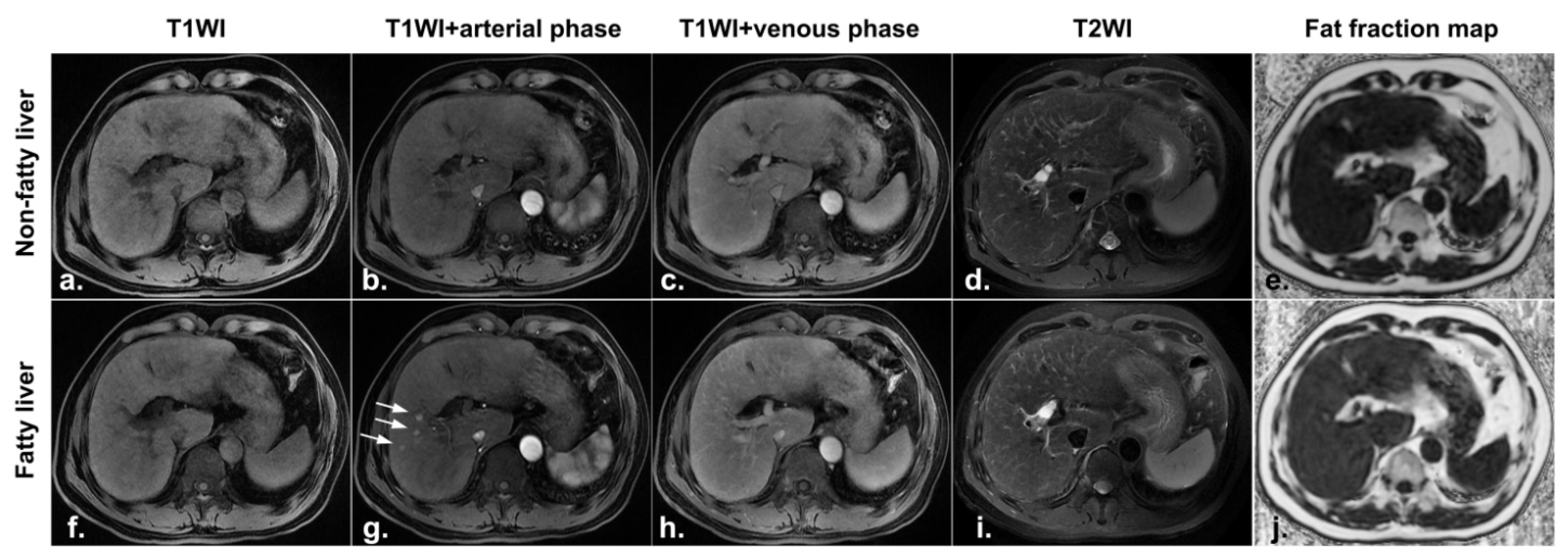 Quantification of Liver Fat Content after Radiofrequency Ablation for ...