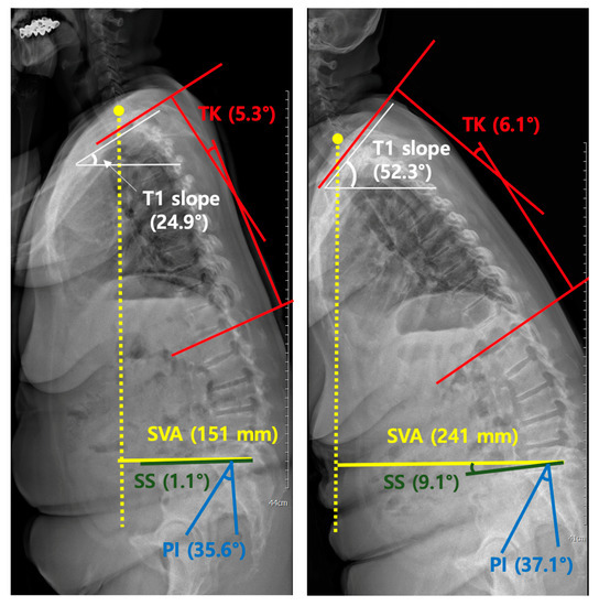 Variation in Sagittal Alignment Parameters in Adult Patients before ...