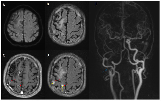 The Clinical Significance of the Hyperintense Acute Reperfusion Marker ...