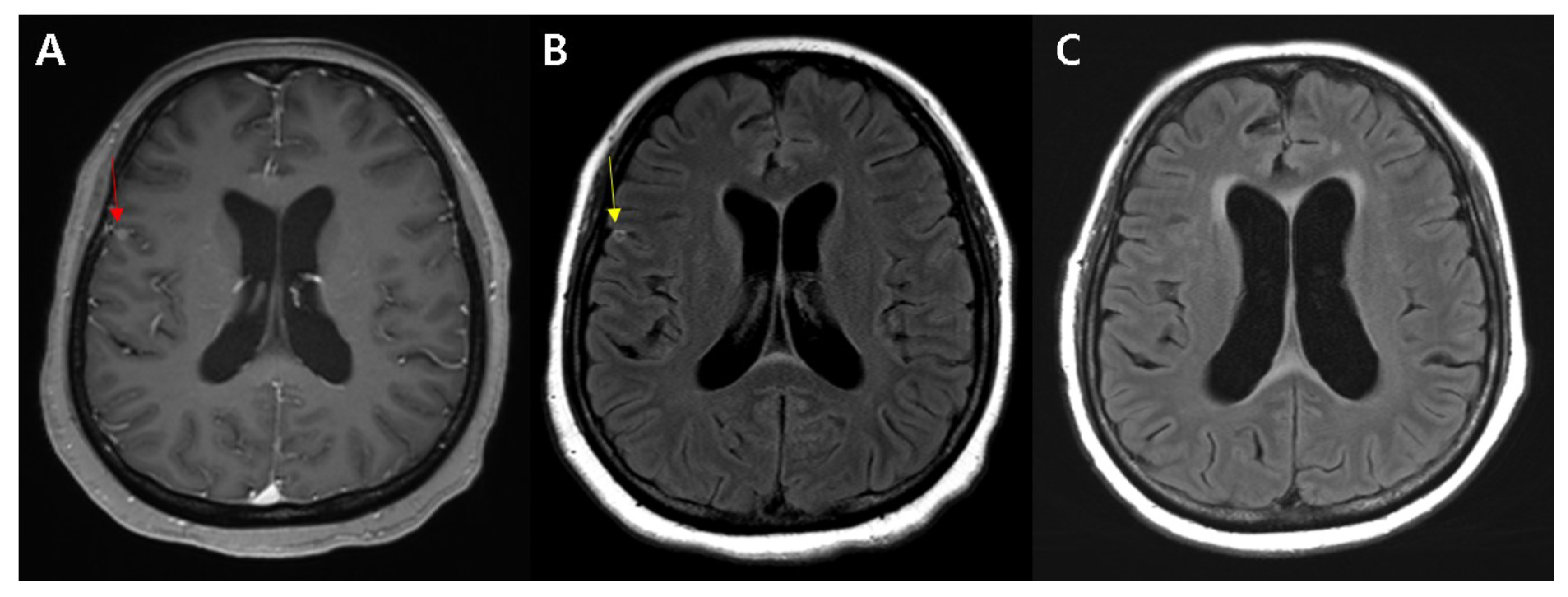 The Clinical Significance of the Hyperintense Acute Reperfusion Marker ...