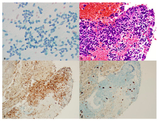INSM1, a Novel Biomarker for Detection of Neuroendocrine Neoplasms ...