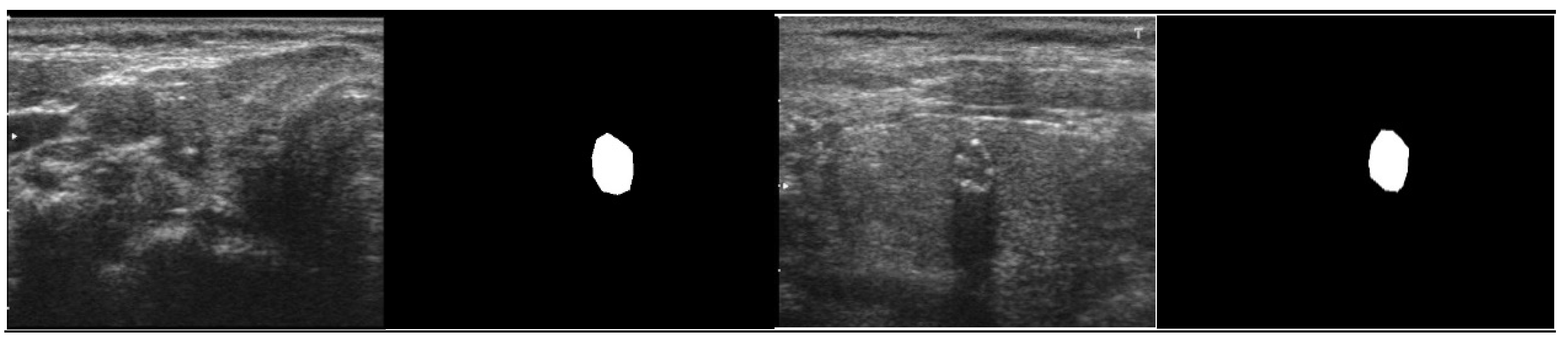 Deep Learning Based Fast Screening Approach on Ultrasound Images for ...