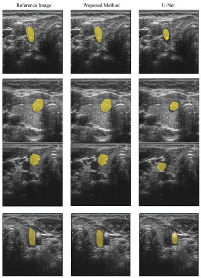 Deep Learning Based Fast Screening Approach on Ultrasound Images for Thyroid Nodules Diagnosis