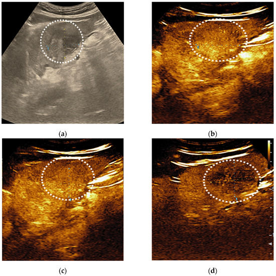 Role of Contrast-Enhanced Ultrasonography in Hepatocellular Carcinoma ...