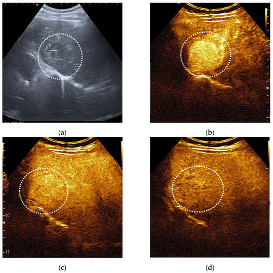 Role of Contrast-Enhanced Ultrasonography in Hepatocellular Carcinoma ...