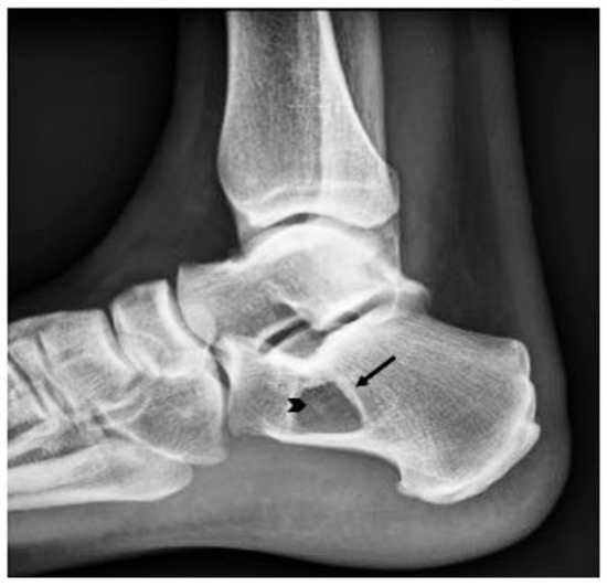 Symptomatic Intraosseous Lipoma of the Calcaneum