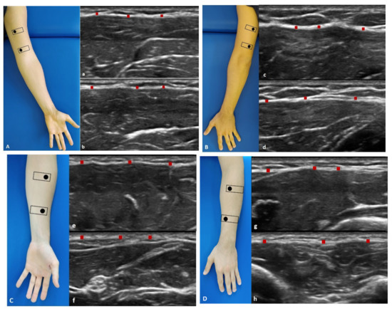 Diagnostics | Free Full-Text | Ultrasound Imaging of Brachial and ...