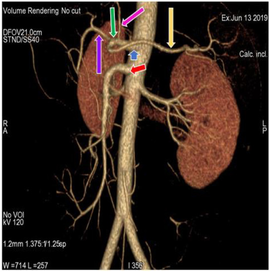 Unraveling Variations in Celiac Trunk and Hepatic Artery by CT ...