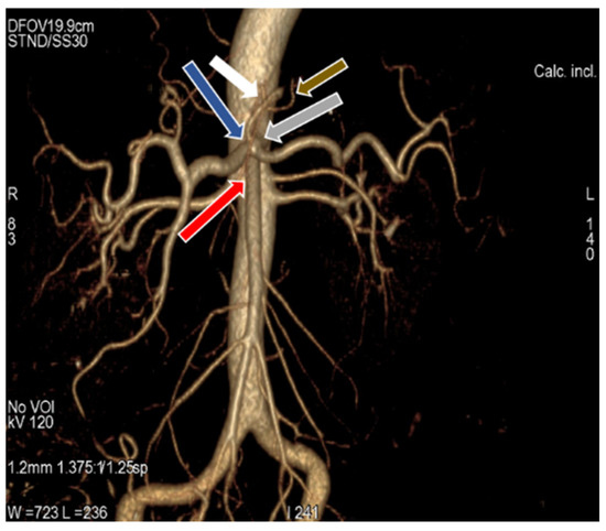 Unraveling Variations in Celiac Trunk and Hepatic Artery by CT ...