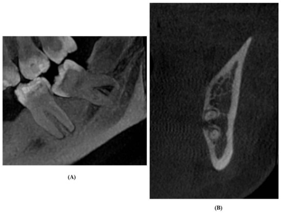 Diagnostics | Free Full-Text | Comparison of Digital OPG and CBCT in Assessment of Risk Factors ...
