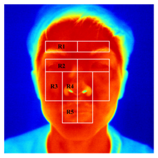 Diagnostics | Free Full-Text | Facial Paralysis Detection in Infrared ...