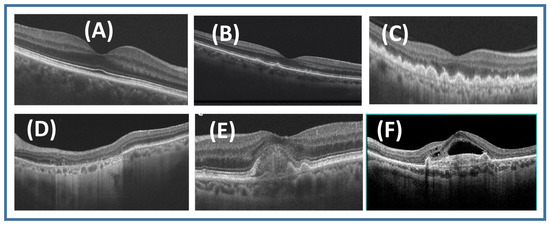 Role of Optical Coherence Tomography Imaging in Predicting Progression ...