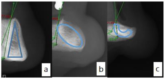 Analysis of Residual Ridge Morphology in a Group of Edentulous Patients ...