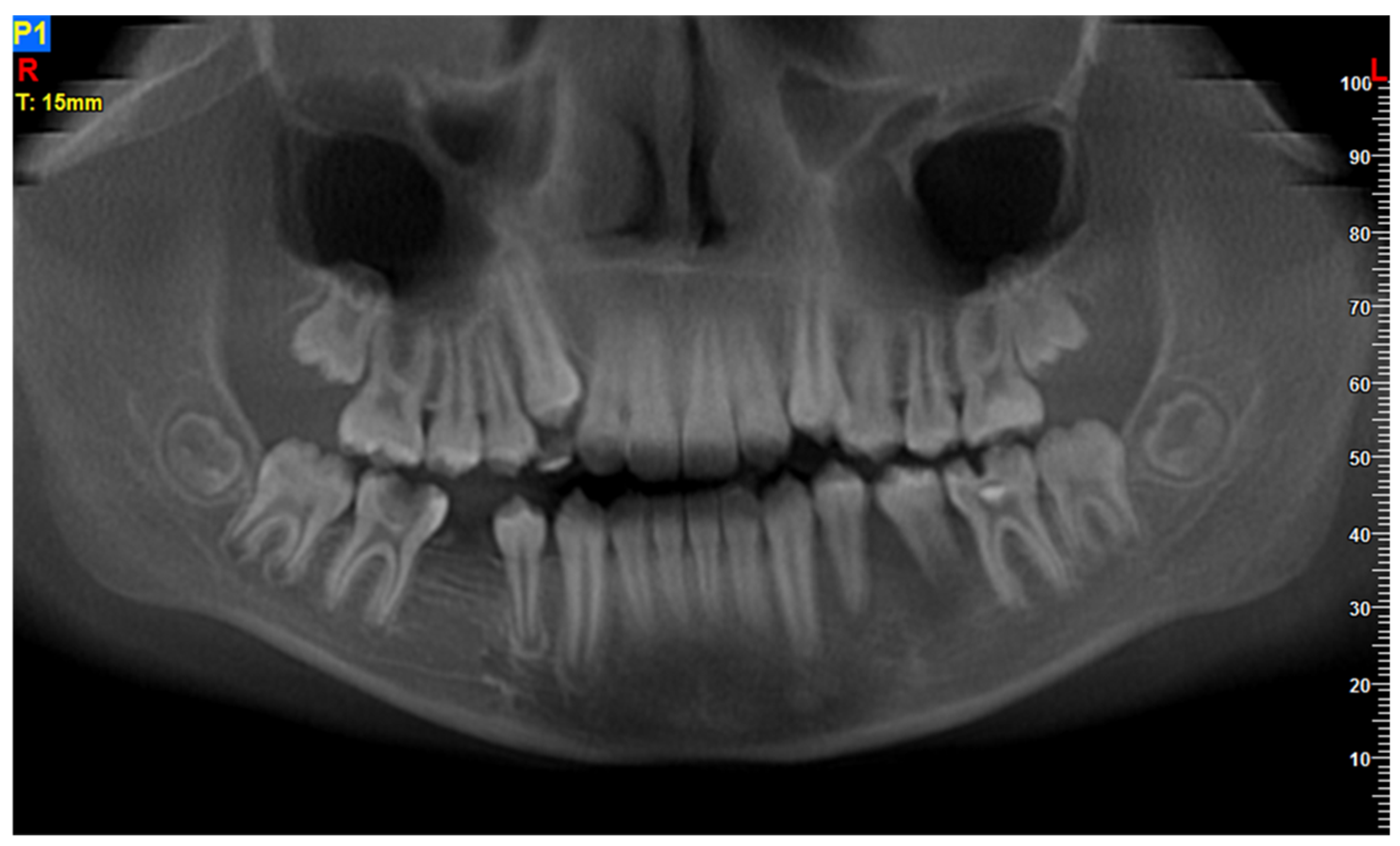 The Primary Outbreaks of Burkitt Lymphoma in the Oral Cavity. A Report ...